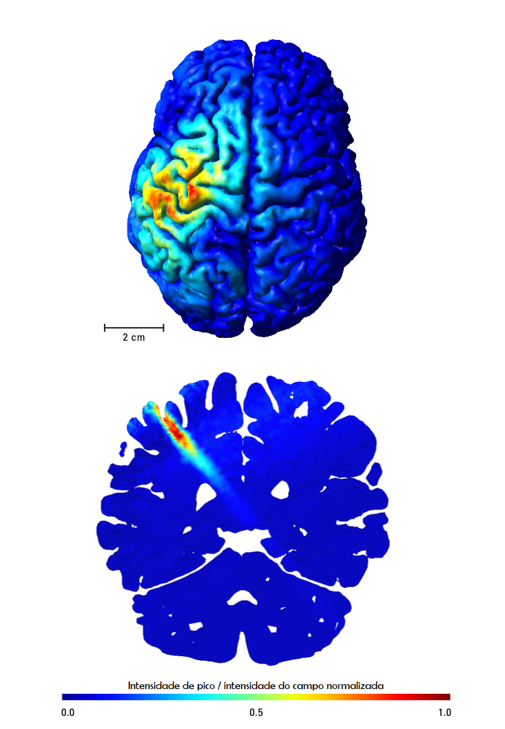 NeuroFUS PRO - Proibrás